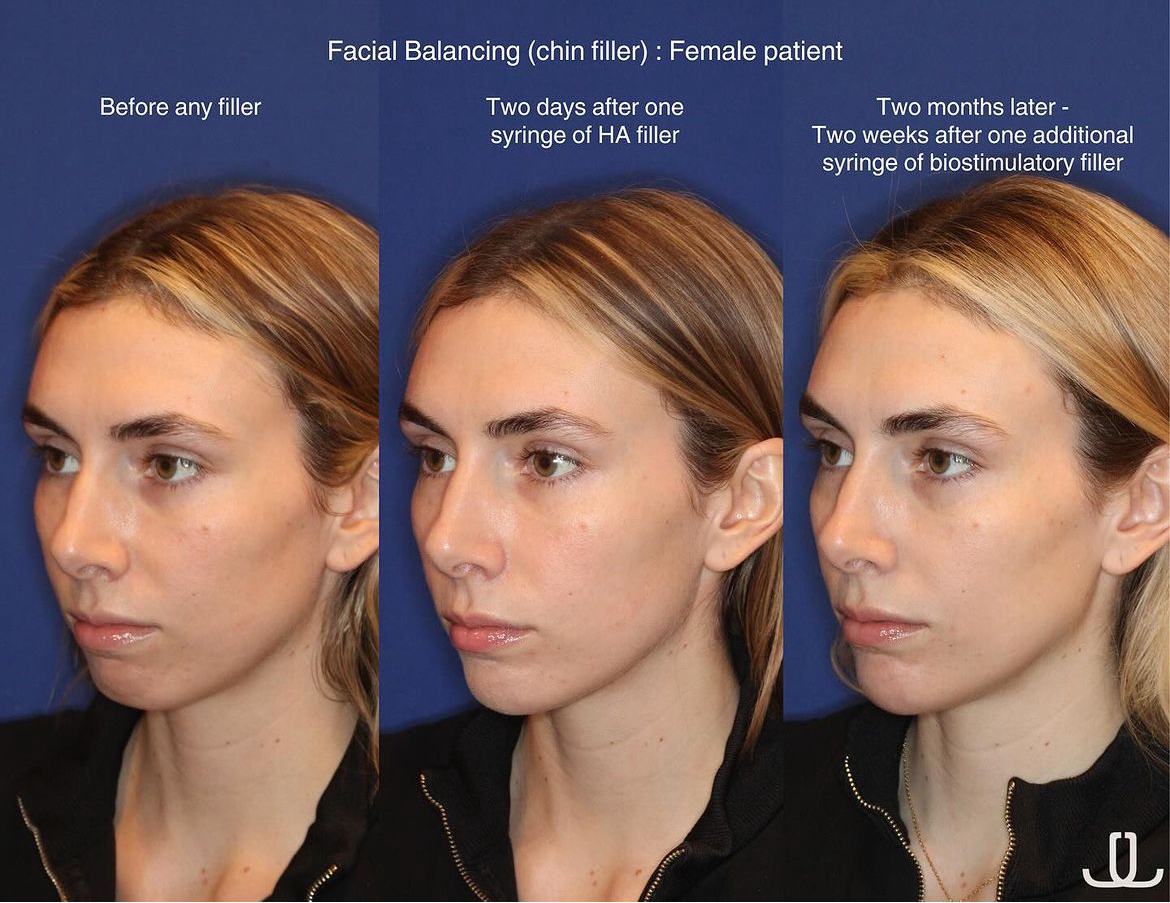 Facial Balancing with Botox & Fillers: Is This Right for You? | Dr. Jennifer Levine