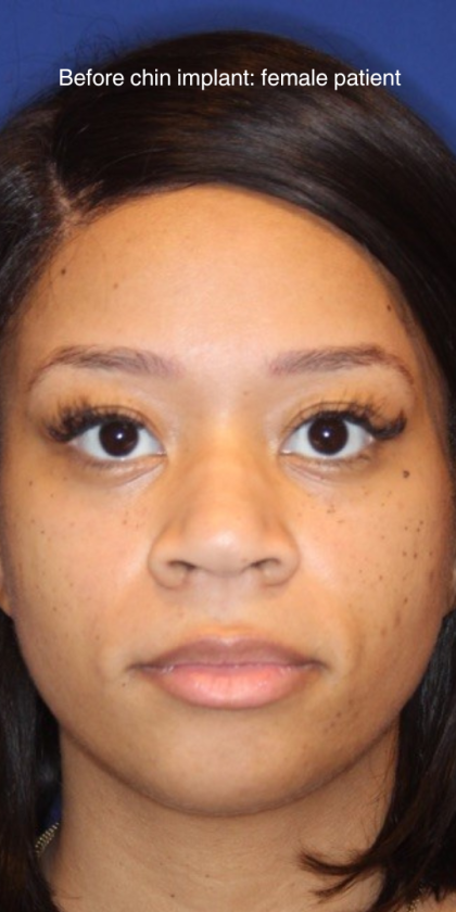 Patient #13350 Chin Augmentation Before and After Photos New York, NY ...