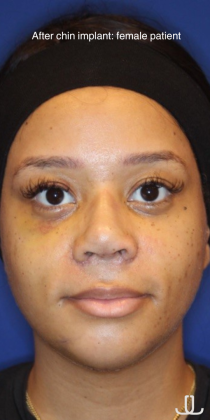 Patient #13350 Chin Augmentation Before and After Photos New York, NY ...
