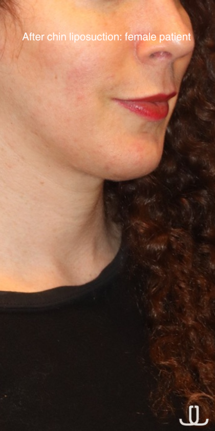 Patient #15735 Chin Liposuction Before and After Photos New York, NY ...