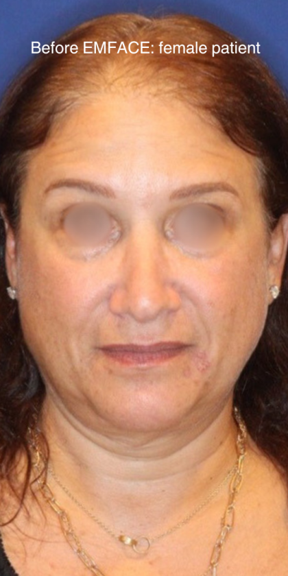 Patient #13906 Emface Before and After Photos New York, NY - Plastic ...