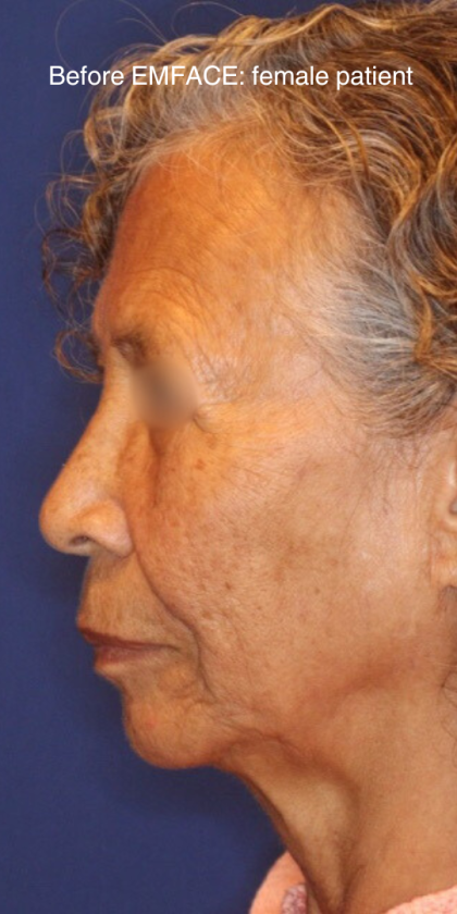Patient #13905 Emface Before and After Photos New York, NY - Plastic ...