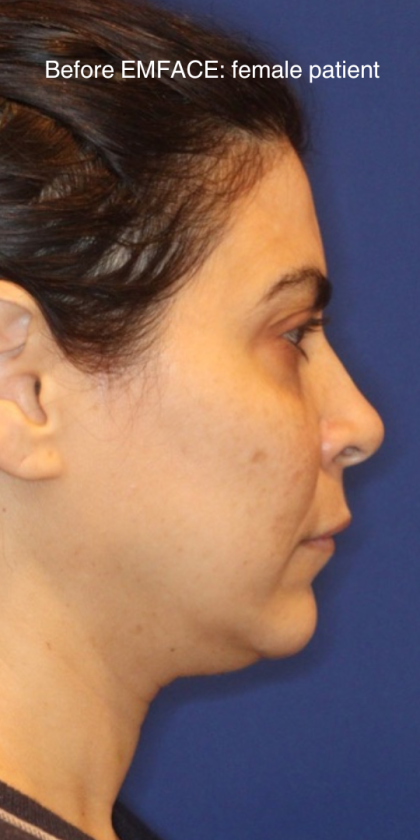 Patient #13904 Emface Before and After Photos New York, NY - Plastic ...