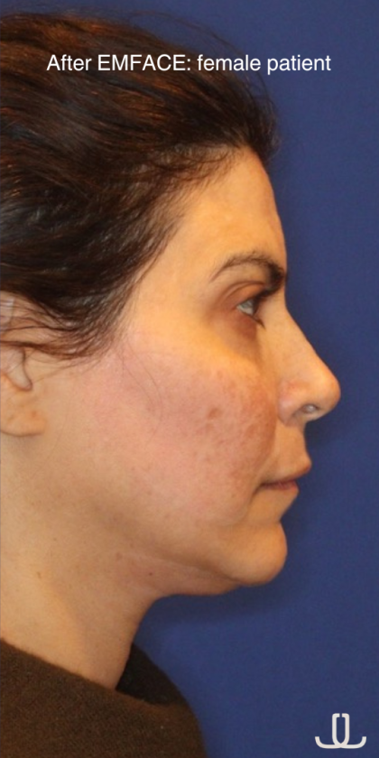 Patient #13904 Emface Before and After Photos New York, NY - Plastic ...