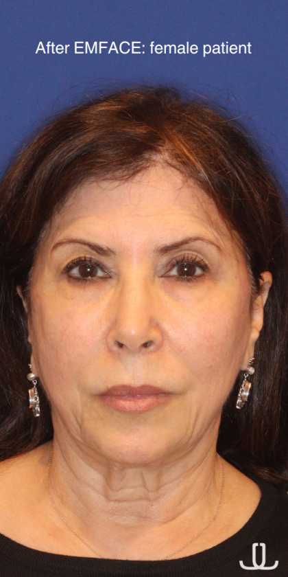Patient #13902 Emface Before and After Photos New York, NY - Plastic ...