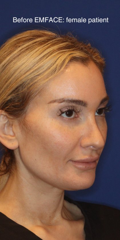 Best Emface NYC | Dr. Jennifer Levine