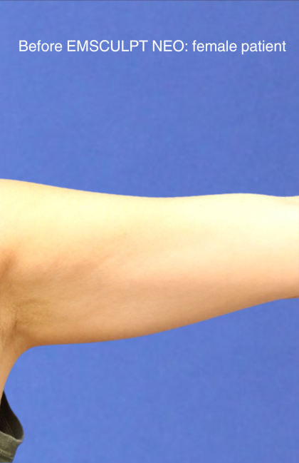Patient #14248 Emsculpt NEO Before and After Photos New York, NY ...