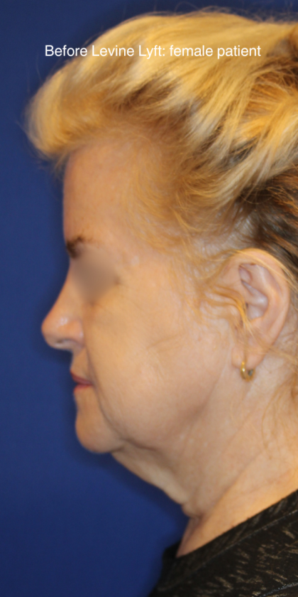 Patient #15692 Facelift / Neck Lift Before and After Photos New York ...