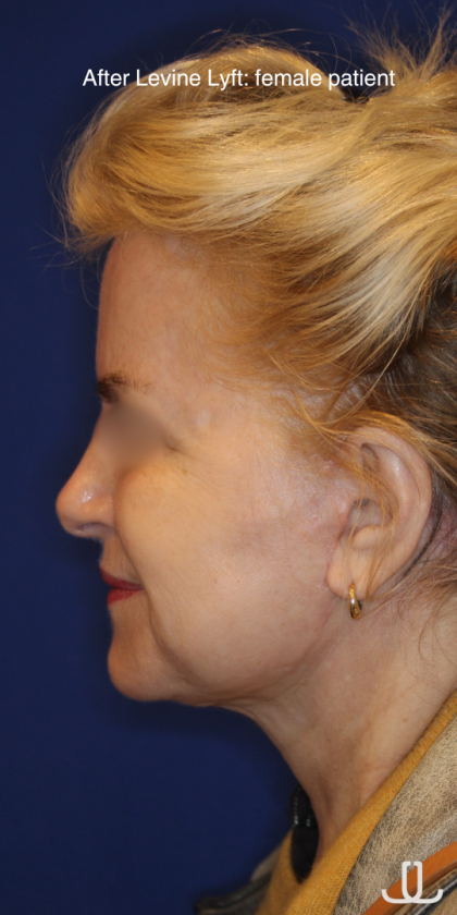 Patient #15692 Facelift / Neck Lift Before and After Photos New York ...