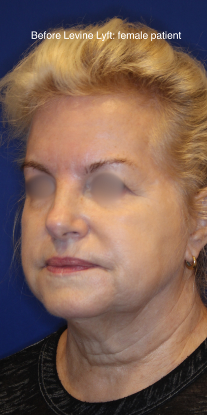 Patient #15692 Facelift / Neck Lift Before and After Photos New York ...