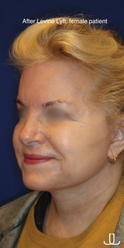 Patient #15692 Facelift / Neck Lift Before and After Photos New York ...