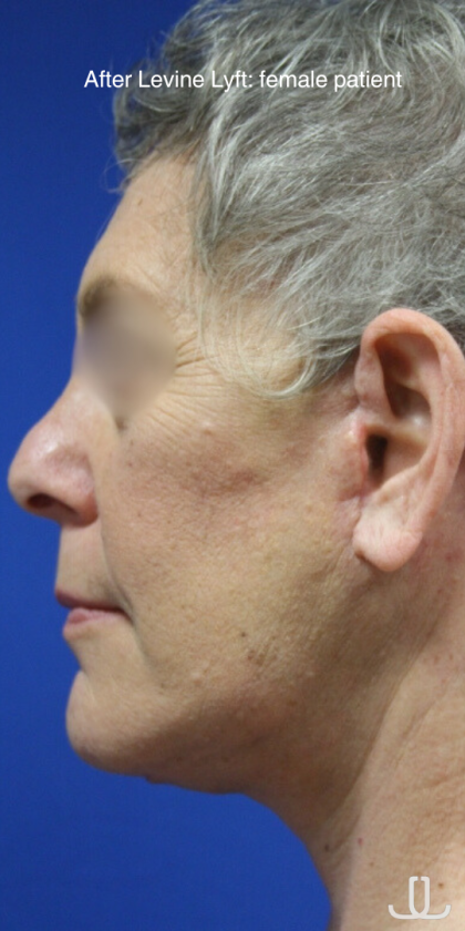 Patient #15098 Facelift / Neck Lift Before and After Photos New York ...