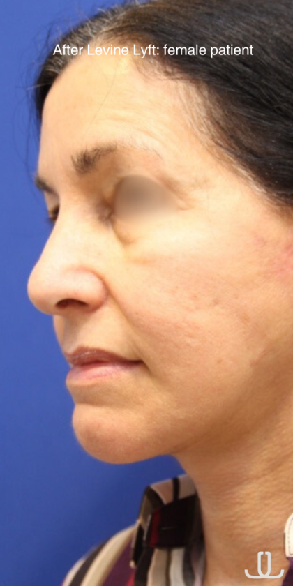 Patient #15749 Facelift / Neck Lift Before and After Photos New York ...