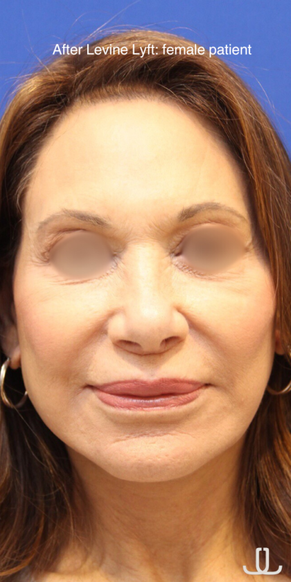 Patient #15096 Facelift / Neck Lift Before and After Photos New York ...