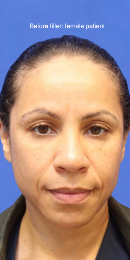 Patient #15574 Dermal Fillers Before and After Photos New York, NY ...