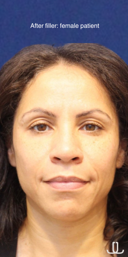 Patient #15574 Dermal Fillers Before and After Photos New York, NY ...