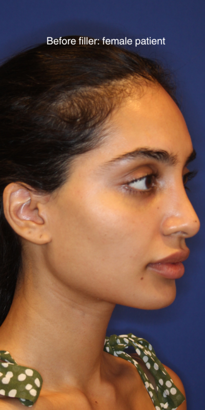 Patient #13856 Dermal Fillers Before and After Photos New York, NY ...