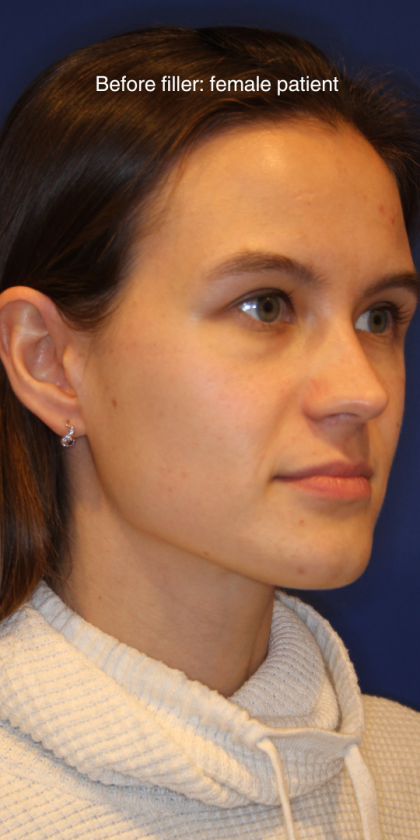 Patient #13859 Dermal Fillers Before and After Photos New York, NY ...