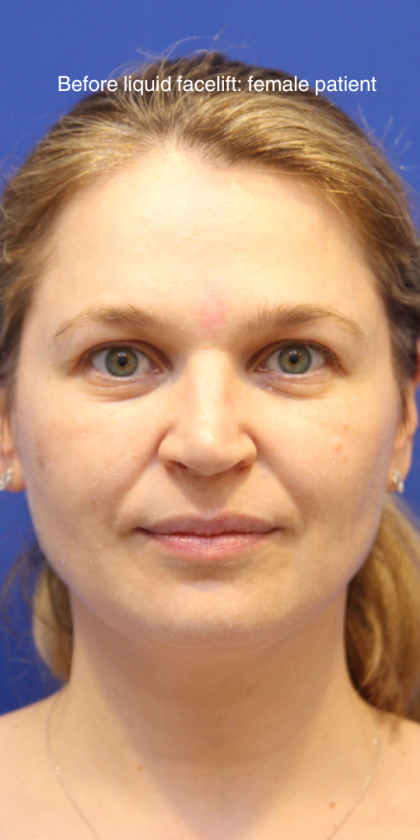 Patient #15794 Liquid Facelift Before and After Photos New York, NY ...