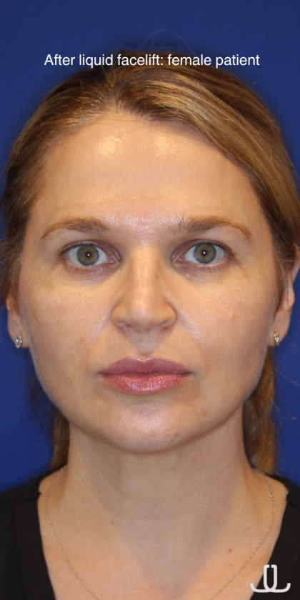 Patient #15794 Liquid Facelift Before and After Photos New York, NY ...