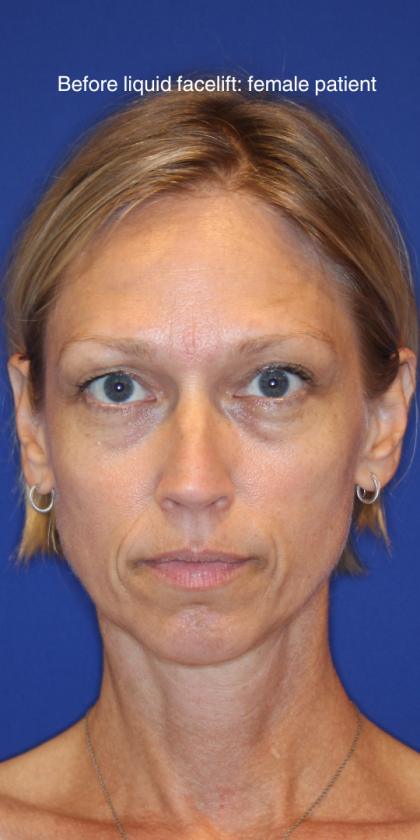 Patient #15793 Liquid Facelift Before and After Photos New York, NY ...