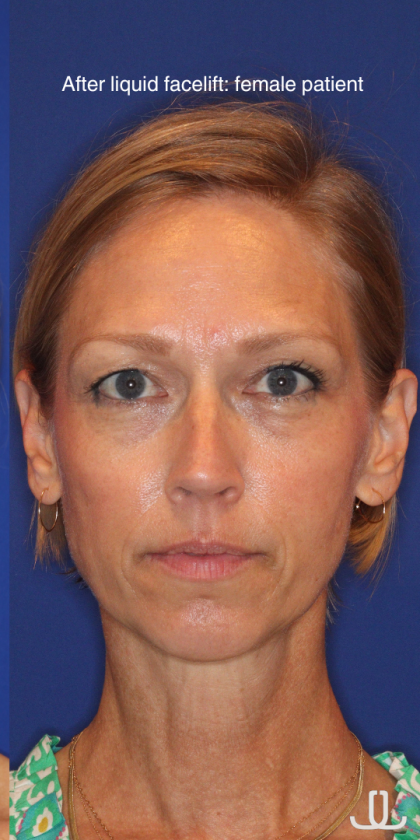 Patient #15793 Liquid Facelift Before and After Photos New York, NY ...