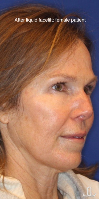 Patient #15792 Liquid Facelift Before and After Photos New York, NY ...