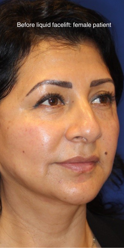 Patient #15791 Liquid Facelift Before and After Photos New York, NY ...