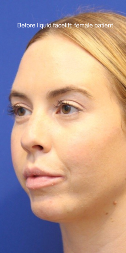 Patient #15790 Liquid Facelift Before and After Photos New York, NY ...