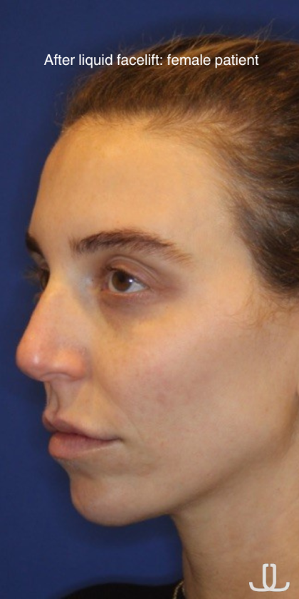 Best Liquid Facelift NYC | Dr. Jennifer Levine