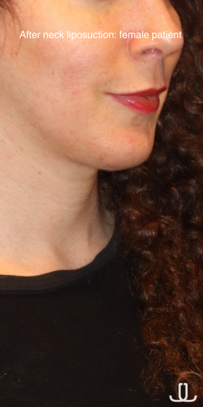 Patient #15836 Neck Liposuction Before and After Photos New York, NY ...