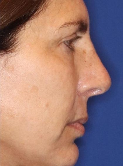 Patient #13560 Septoplasty Before and After Photos New York, NY ...