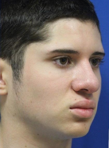 Patient #13596 Septoplasty Before and After Photos New York, NY ...