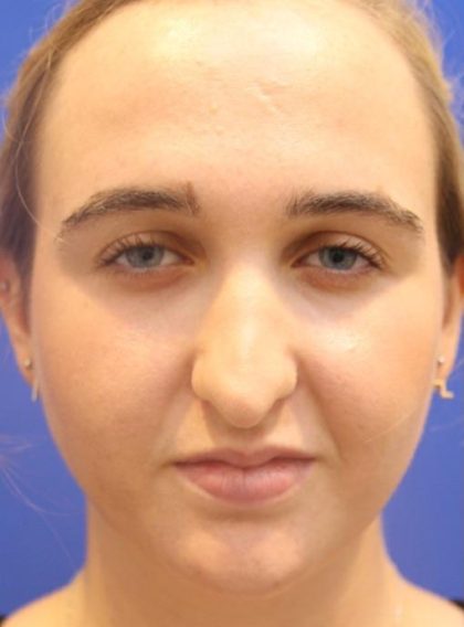 Patient #13537 Septoplasty Before and After Photos New York, NY ...