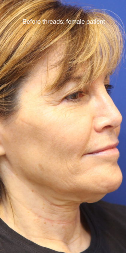 Best Mint PDO Thread Lift NYC | Dr. Jennifer Levine