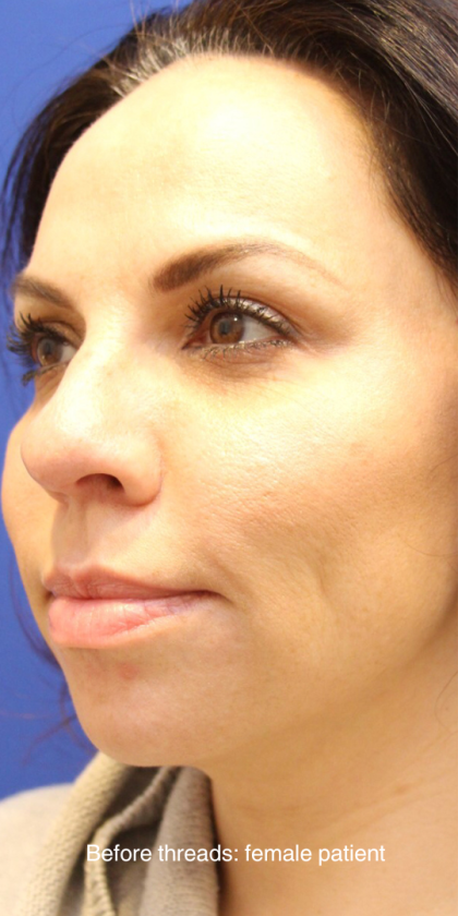 Best Mint PDO Thread Lift NYC | Dr. Jennifer Levine