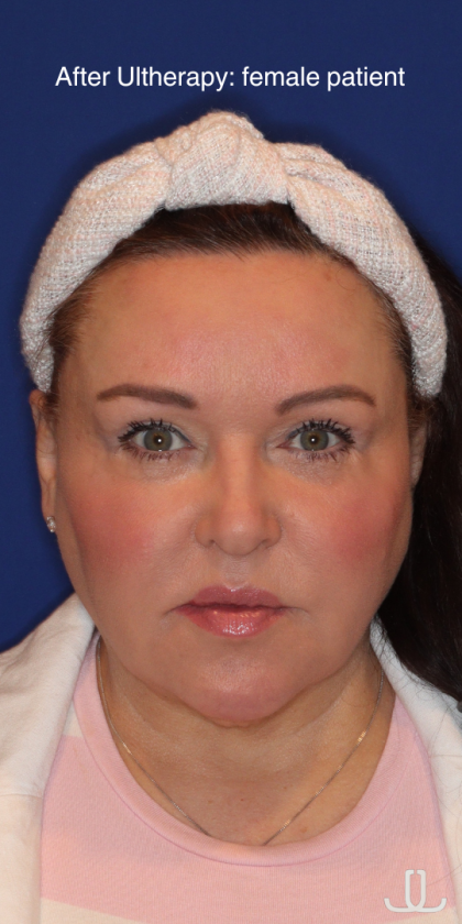 Best Ultherapy NYC | Dr. Jennifer Levine