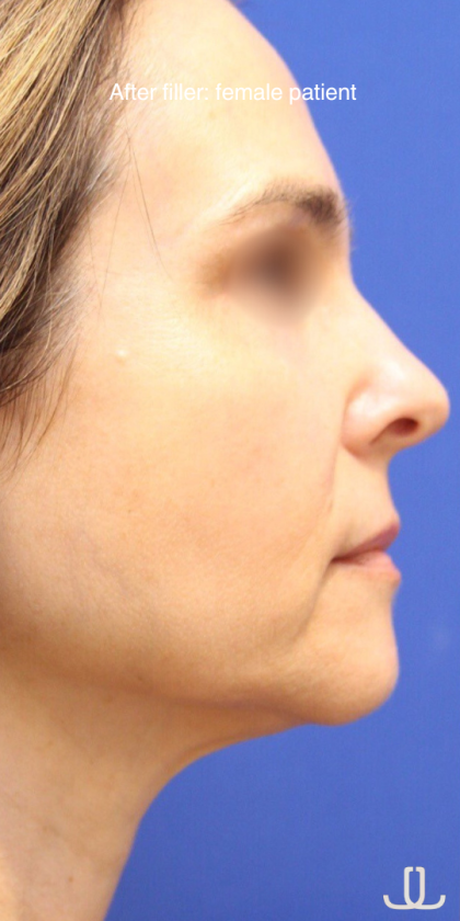 Patient #15394 Dermal Fillers Before and After Photos New York, NY ...