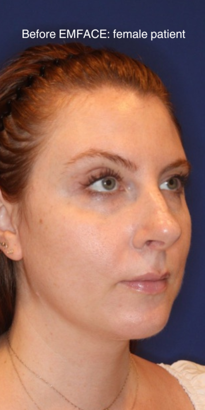 Patient #13908 Emface Before and After Photos New York, NY - Plastic ...