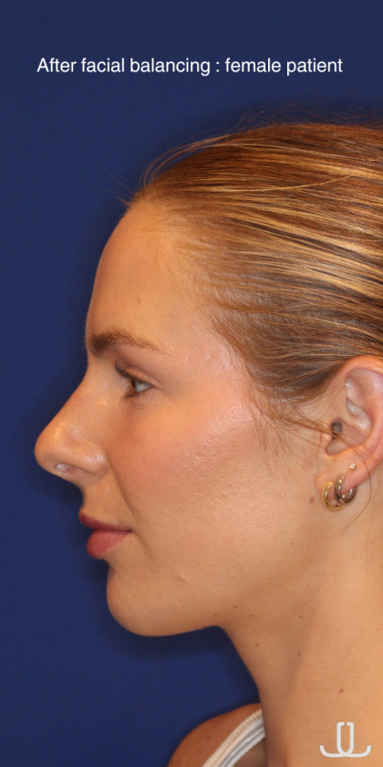 Patient #15543 JL Facial Balancing Before and After Photos New York, NY ...