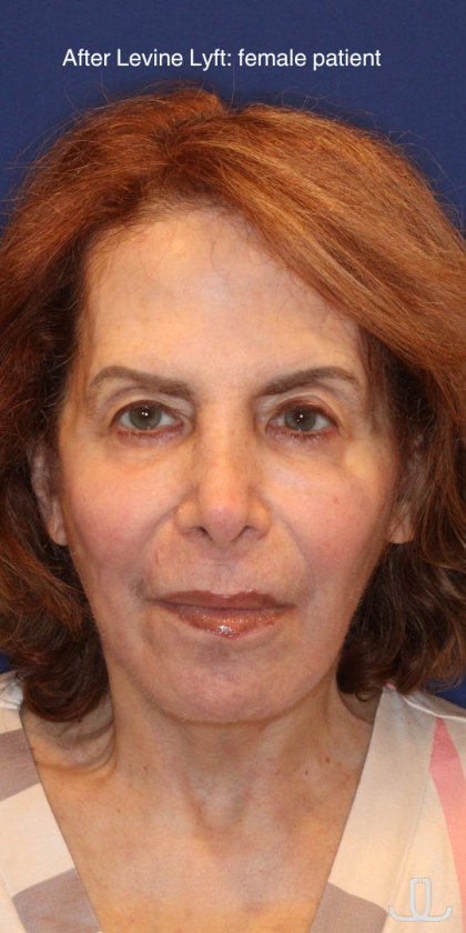 Patient #15094 Facelift / Neck Lift Before and After Photos New York ...