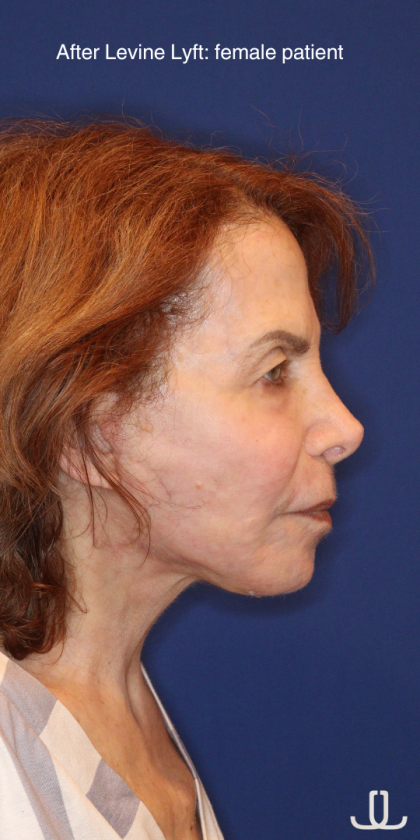 Patient #15094 Facelift / Neck Lift Before and After Photos New York ...