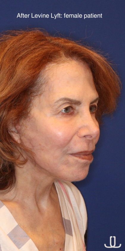 Patient #15094 Facelift / Neck Lift Before and After Photos New York ...