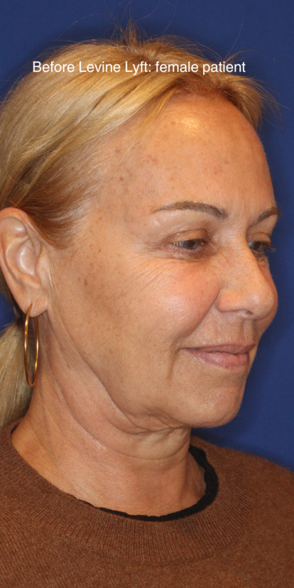 Patient #15100 Facelift / Neck Lift Before and After Photos New York ...