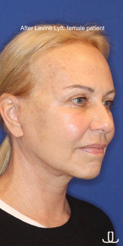 Patient #15100 Facelift / Neck Lift Before and After Photos New York, NY - Plastic Surgery ...