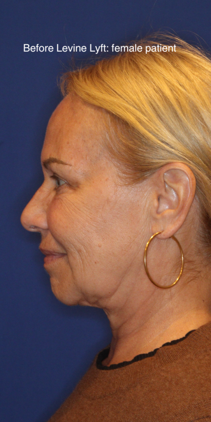 Patient #15100 Facelift / Neck Lift Before and After Photos New York ...