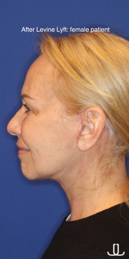 Patient #15100 Facelift / Neck Lift Before and After Photos New York ...