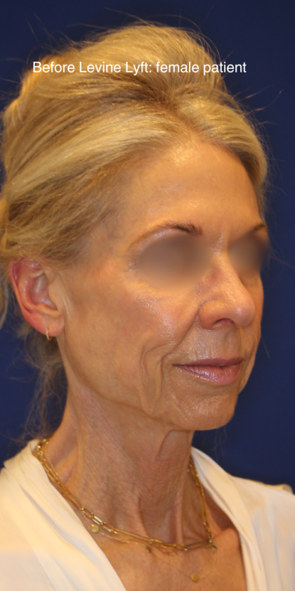 Patient #15101 Facelift / Neck Lift Before and After Photos New York ...