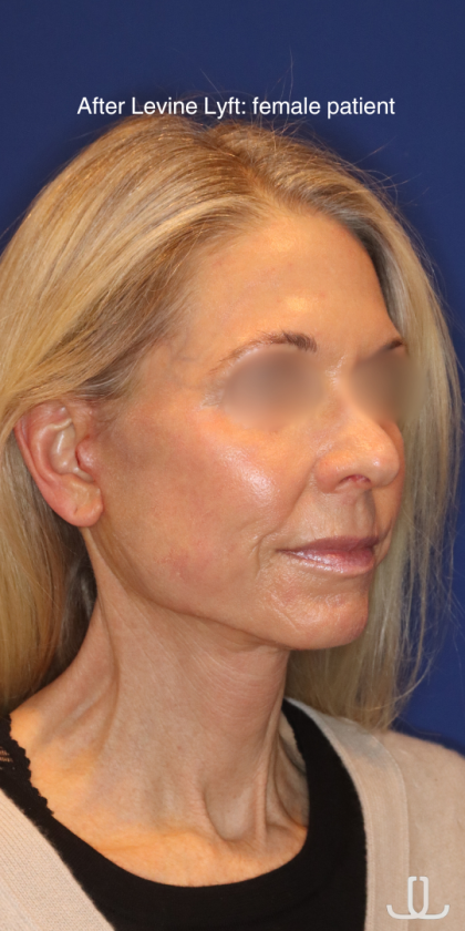 Patient #15101 Facelift / Neck Lift Before and After Photos New York ...