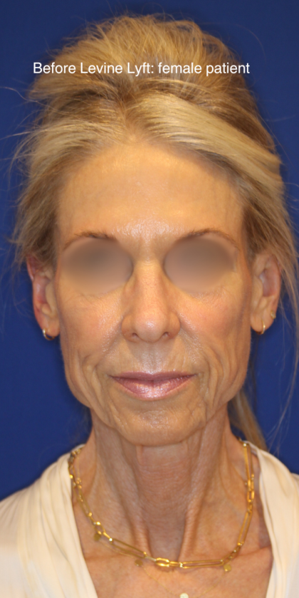 Patient #15101 Facelift / Neck Lift Before and After Photos New York ...